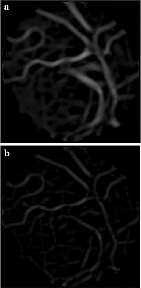 A Gaussian Matched Filter B Adaptive Tophat Transformation Of A Vessel