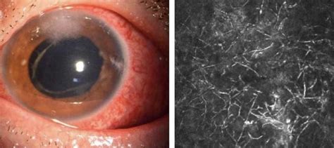 Consideraciones Diagnósticas De La Queratitis Micótica Grupo Franja