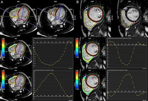 Right Ventricular Strain Analysis By Tissue Tracking Cardiac