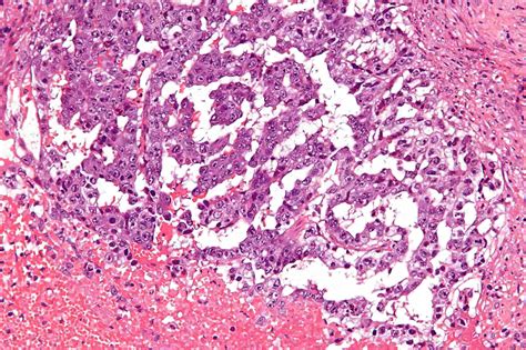 25 Facts About Mediastinal Endodermal Sinus Tumors