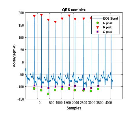 Qrs Complex Detected In Ecg Signal Download Scientific Diagram