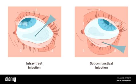 Eyes Injection Types Intravitreal And Subconjunctival Injection Administration Of Medicine