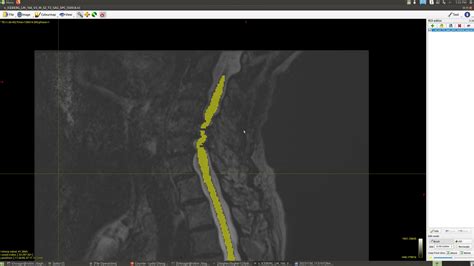 stitching and segmentation sct