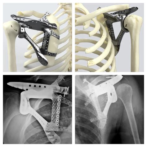Osteobionix Auf Linkedin Osteosarcoma Osteobionix Scapula 77 Kommentare