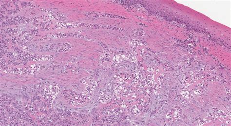 Hyalinizing Clear Cell Carcinoma Ottawa Atlas Of Pathology