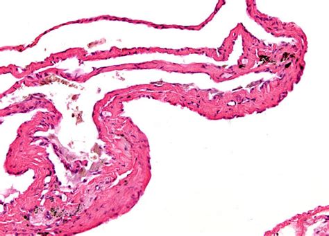 Emphysema At 10x Magnification Nikons Microscopyu