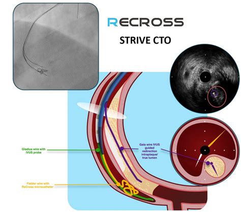Imds On Linkedin Strive Cto Moving The Boundaries Of Pci Treatment