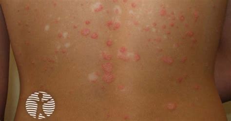 Guttate Psoriasis Image