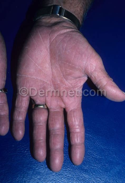 Skin Disease V2 Object Detection Dataset And Pre Trained Model By Skin Disease