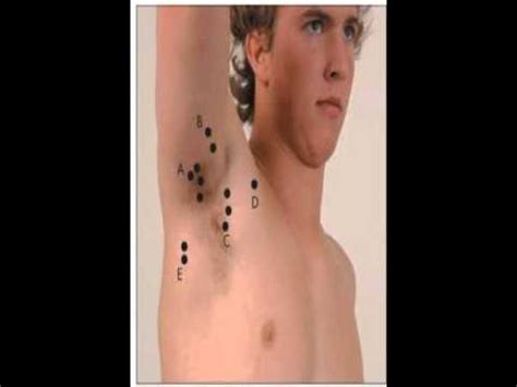 armpit lymph node swelling - YouTube