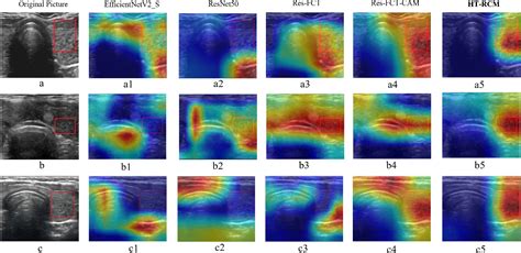 Figure 1 From Ht Rcm Hashimotos Thyroiditis Ultrasound Image