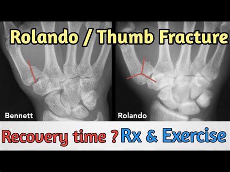 Rolando Fracture Ao