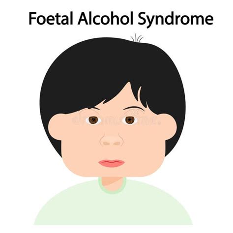 Foetal Alcohol Syndrome Vector Stock Vector Illustration Of