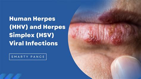 Herpes Virus In Women