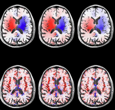 Brainiacs Lab On Linkedin Model Driven Exploration Of Poro Viscoelasticity In Human Brain
