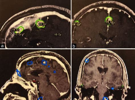 Brain Fast Spoiled Gradient Echo Sequences With Contrast Depicting Download Scientific Diagram