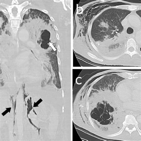 A Chest Radiography On Hospital Day 7 Reveals A Diffuse Consolidation