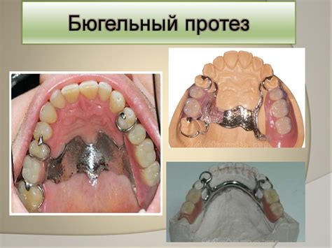 Частичная потеря зубов презентация онлайн