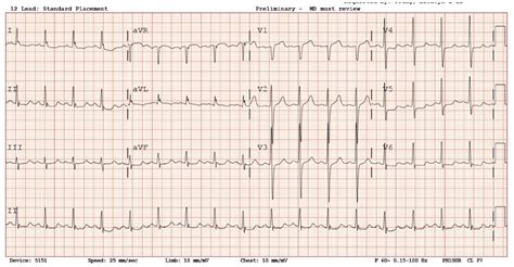 Myocardial Infarction Masking A Rare Case Of Coronary Subclavian Steal