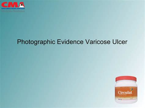 Varicose Ulcer Evidence Part I Circulat Ppt