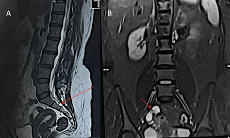 Hitting The Right Nerve A Rare Case Of Vulvodynia From Sacral Tarlov