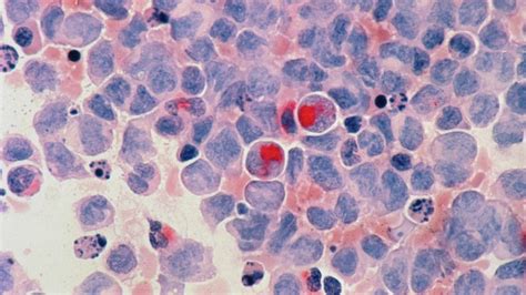 How Next Generation Sequencing Is Helping Cancer Patients