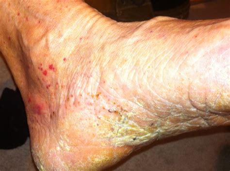 Multiple Erythematous Papular And Non Blanching Rash On Lower Legs Download Scientific Diagram