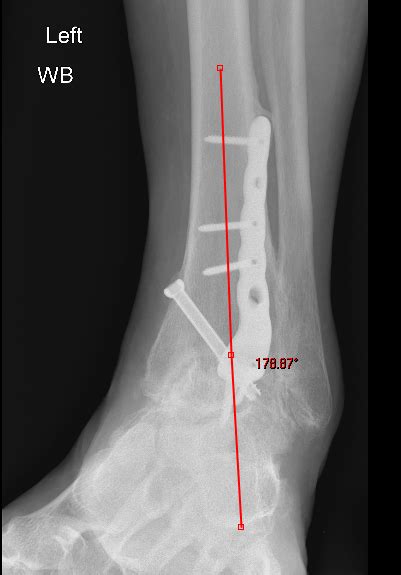 Restoring Full Mobility With Ankle Fusion Andrew Molloy Foot And Ankle Surgery