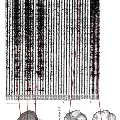 Seizure Spread In The Epileptic Network The Electrode Reconstruction