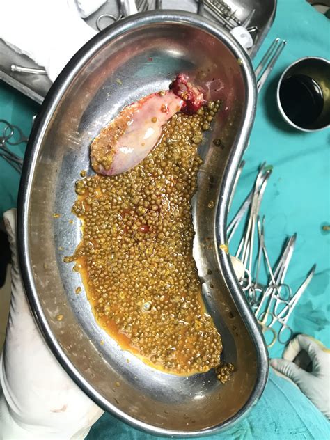 Cholelithiasis Medizzy