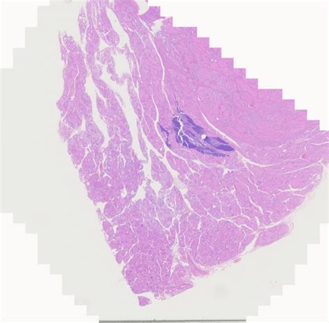 Pathology Outlines Thymic Tissue Within Thyroid Gland