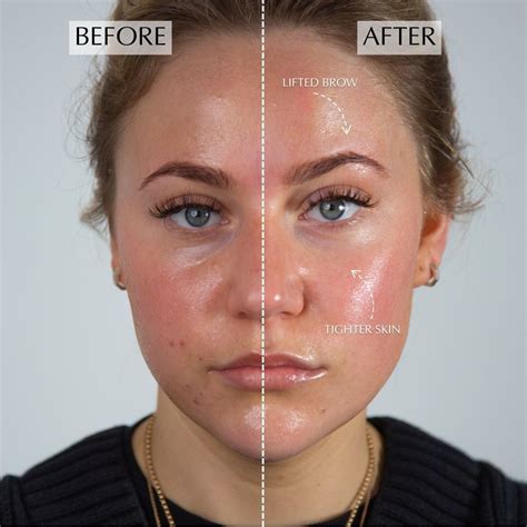 Ziip Halo Microcurrent Facial Device Ziip