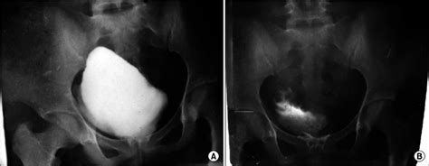 A Micturating Cystourethrogram Mcu Showing Reconstructed Bladder