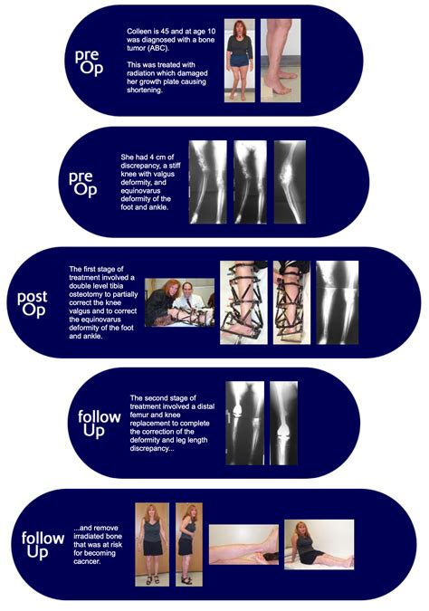 Double Level Tibial Osteotomy And Joint Replacement Limb Lengthening
