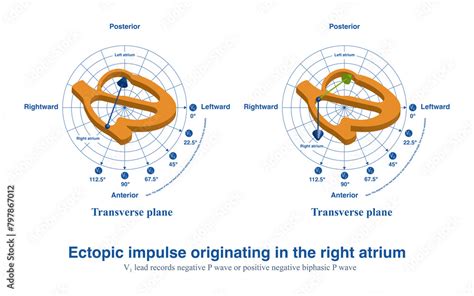 When Ectopic Impulses From The Anterior Wall Of The Right Atrium Produce A Completely Negative P