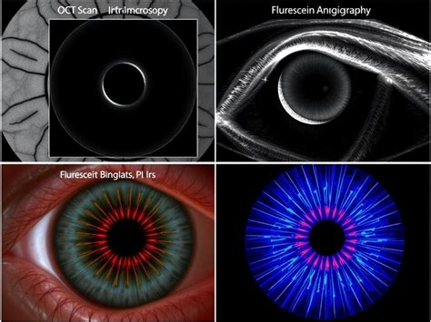 Iris Medical Term Anatomy Functions And Related Conditions