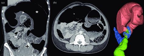 A Typical Sigmoid Volvulus Sv In A 51 Year Old Woman A Coronal Ct