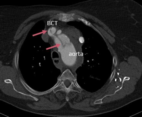 Aortic Dissection Stroke Manual