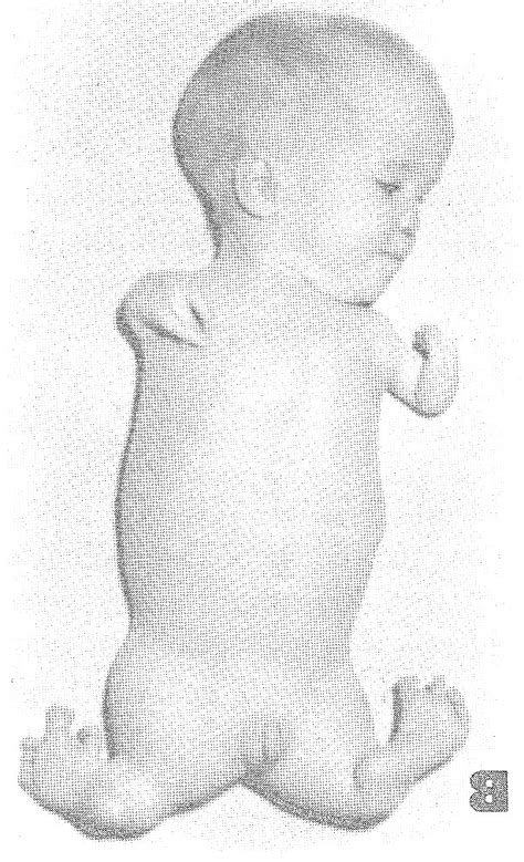 10d Thalidomide And The Apology That Angered Its Victims