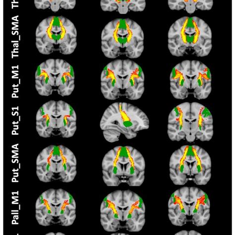 Reconstructed White Matter Tracts In Healthy Subjects Hc Right Dst