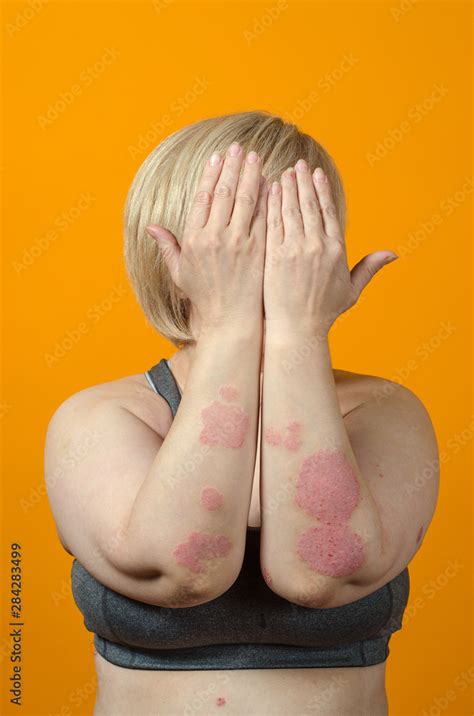Dermatological Skin Disease Psoriasis Eczema Dermatitis Allergies