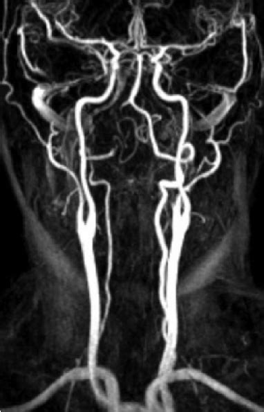 Right V4 Stenosis On Cervical Magnetic Resonance Angiography Download Scientific Diagram