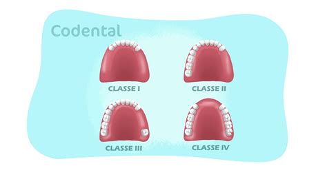 Classificação De Kennedy E Suas Modificações Um Guia Completo