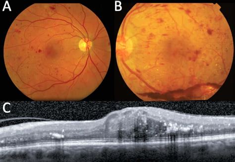 Diabetic Maculopathy