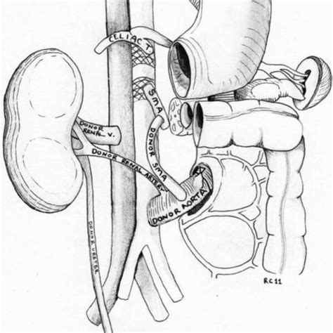 Illustration Depicting Aorto Aortic Bypass Renal Transplantation And
