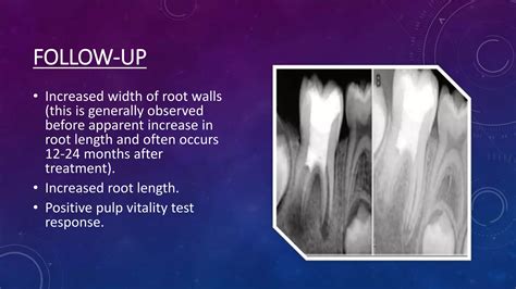 Pulp Revascularization Pptx