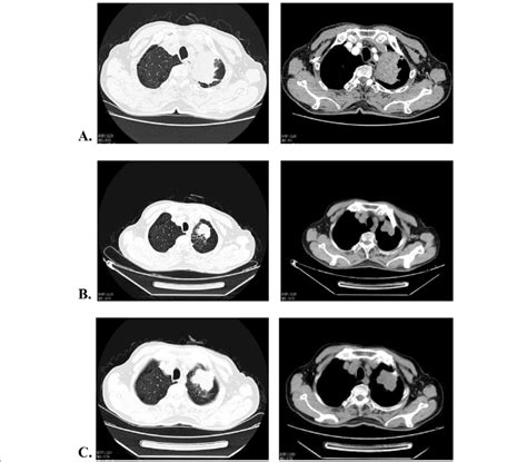 Computed Tomography Scans Of The Patient Showing The Tumor Responses To