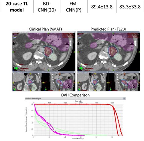 Transfer Learning For Fluence Map Prediction In Adrenal Stereotactic Body Radiation Therapy Pmc