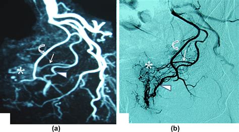 Contrast Enhanced Magnetic Resonance Angiography In The Identification Of Prostatic Arterial