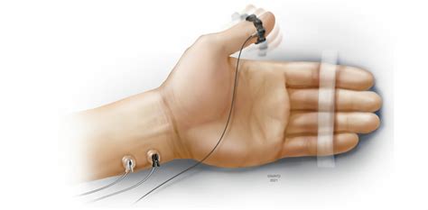 Advancements In Quantitative Neuromuscular Monitoring Anesthesia Experts
